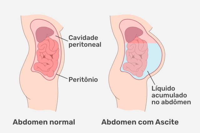 Ascite: o que é, sintomas, causas e tratamento - Tua Saúde - Viva Com ...